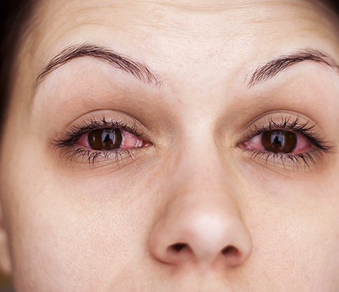 Blepharitis | Auburn Eye Care